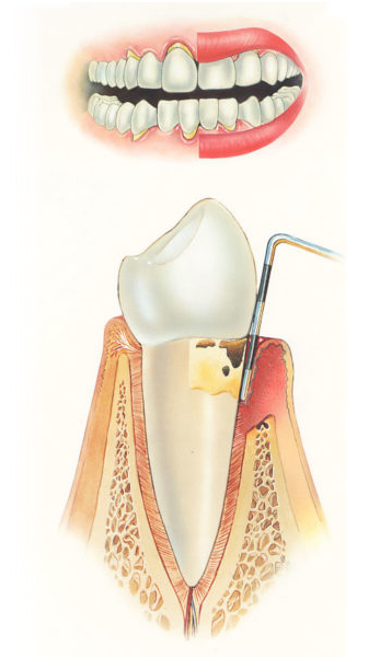 Parodontologie / laserunterstützt | Zahnärztliche Praxis Klaus Habel